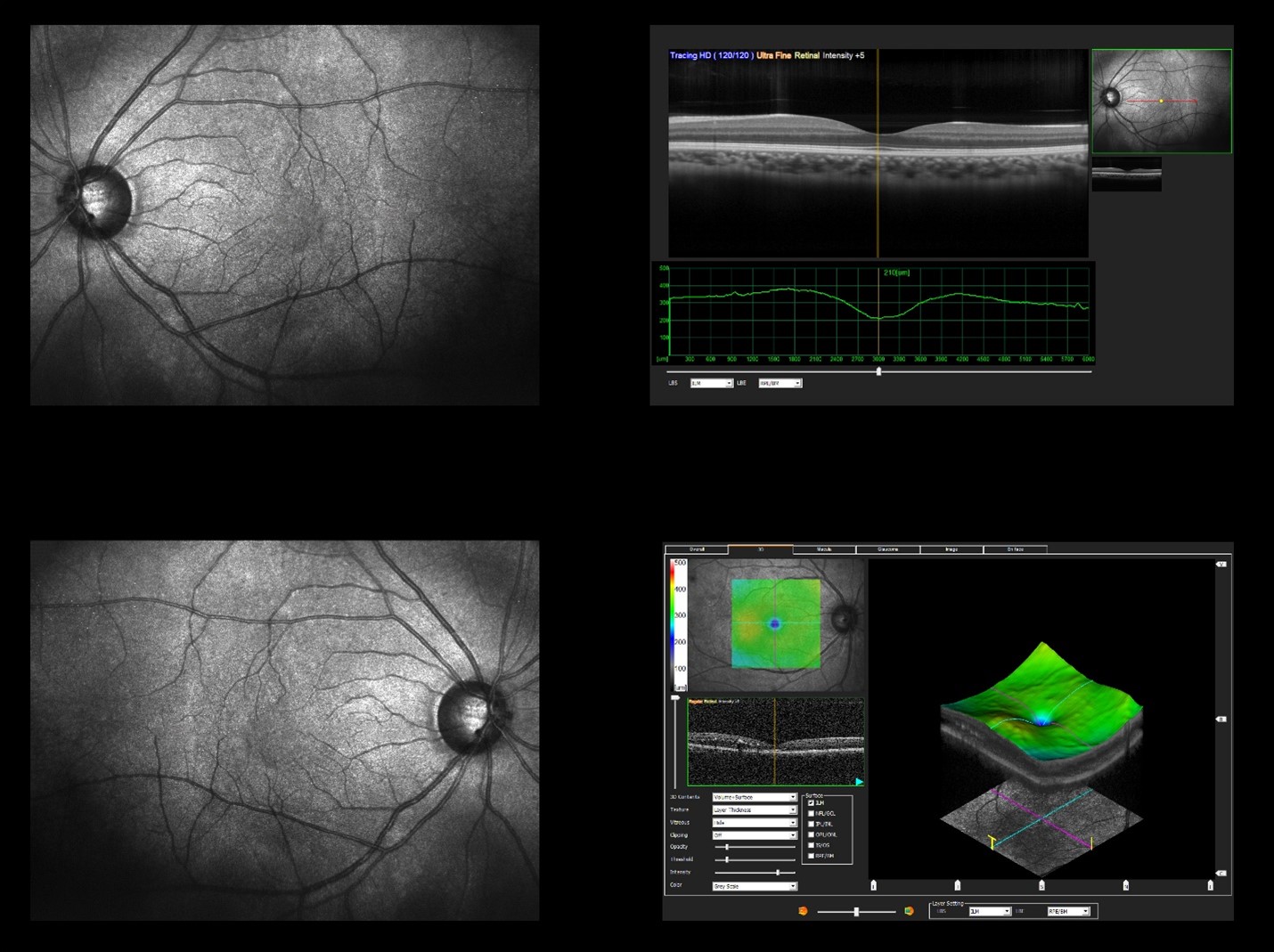 Optical Coherence Tomography Louisiana Eye Care Denham Springs LA